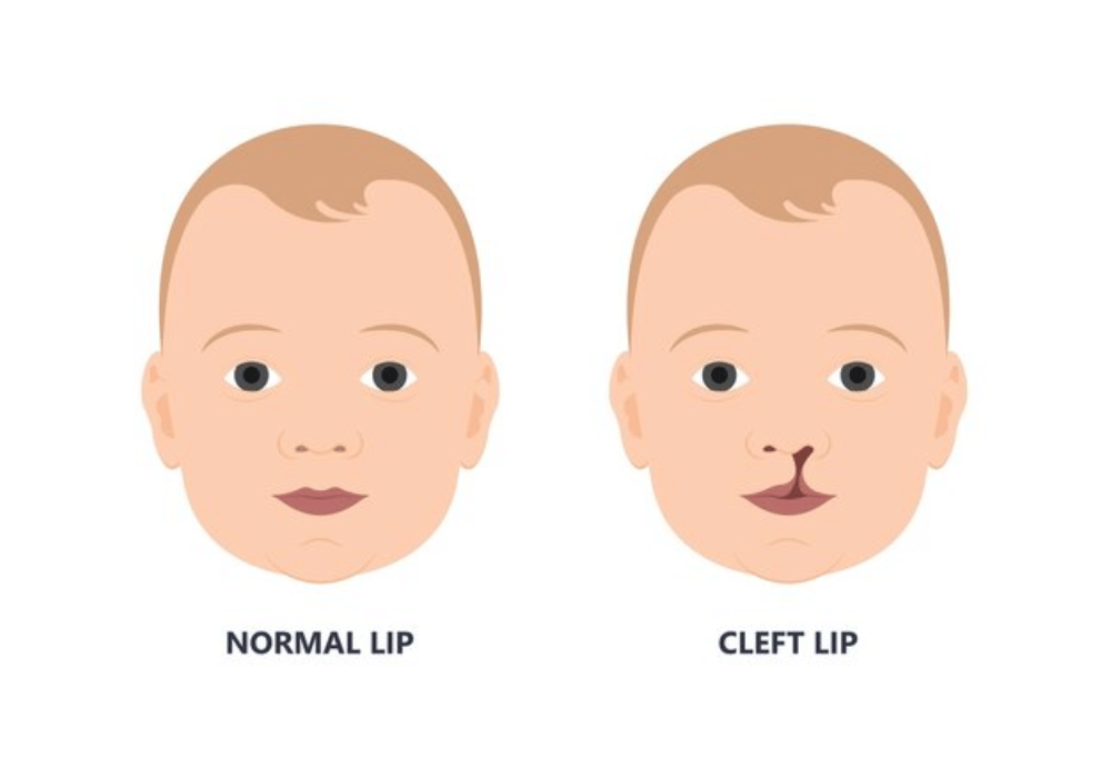 Congenital Facial Deformities - Reconface India