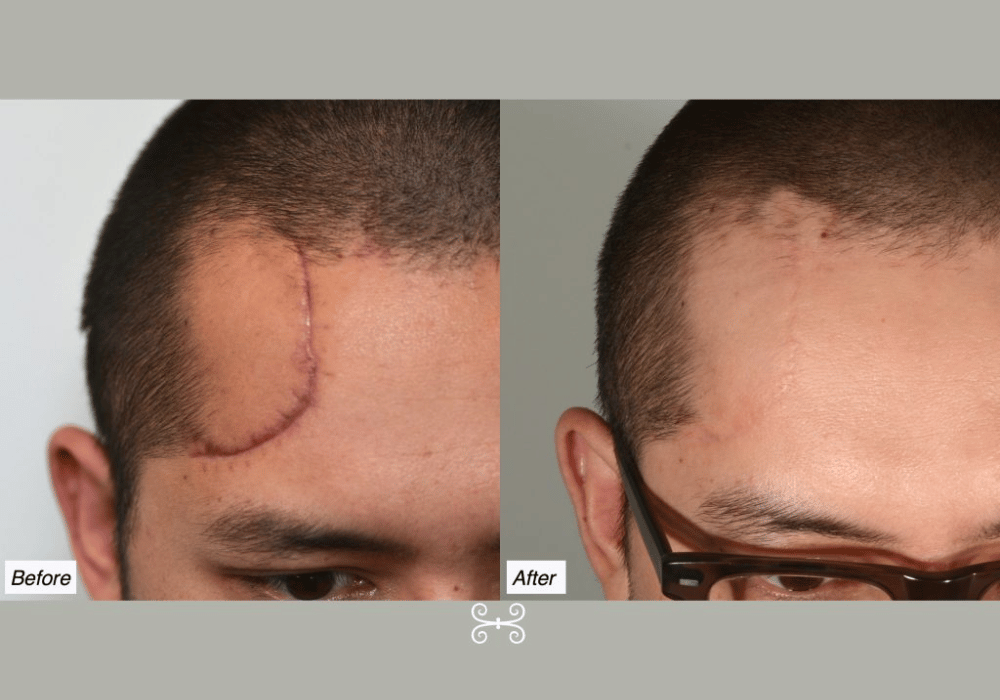 Scar Revisions - Reconface India